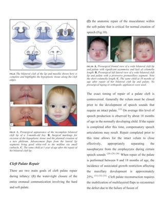 Article of Reconstruction of cleft lip and palate defect | PDF