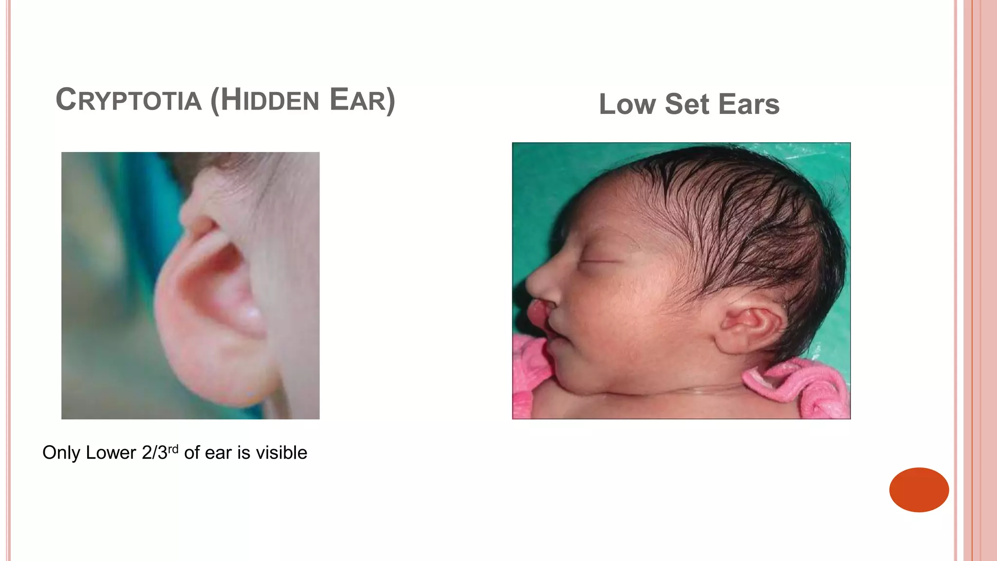 Reconstruction of ear | PPTX