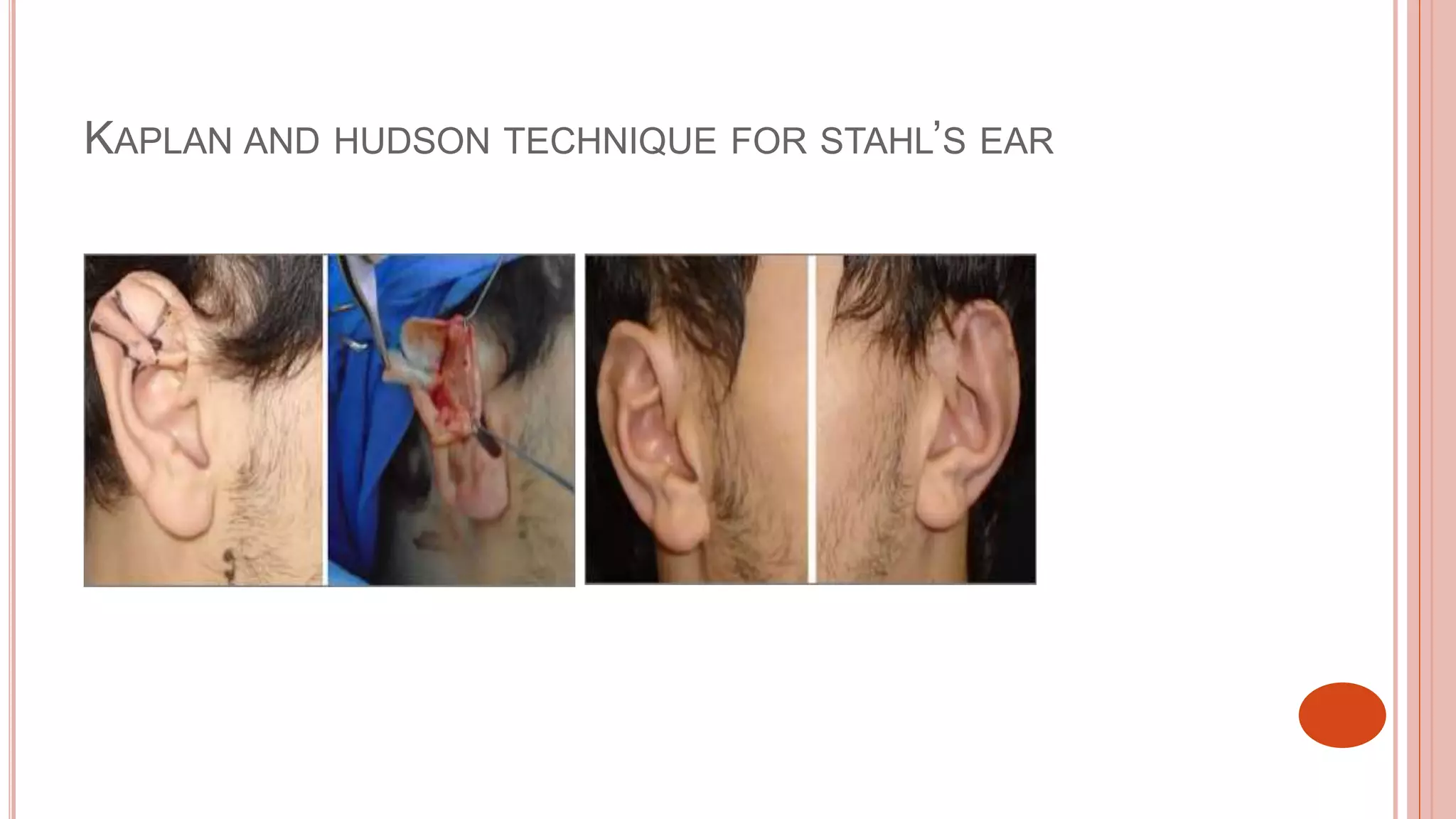 Reconstruction of ear | PPTX
