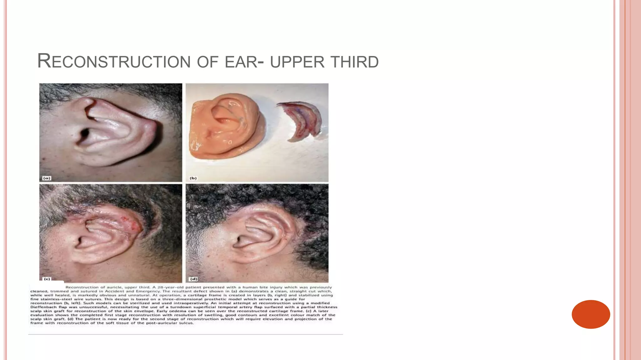 Reconstruction of ear | PPTX