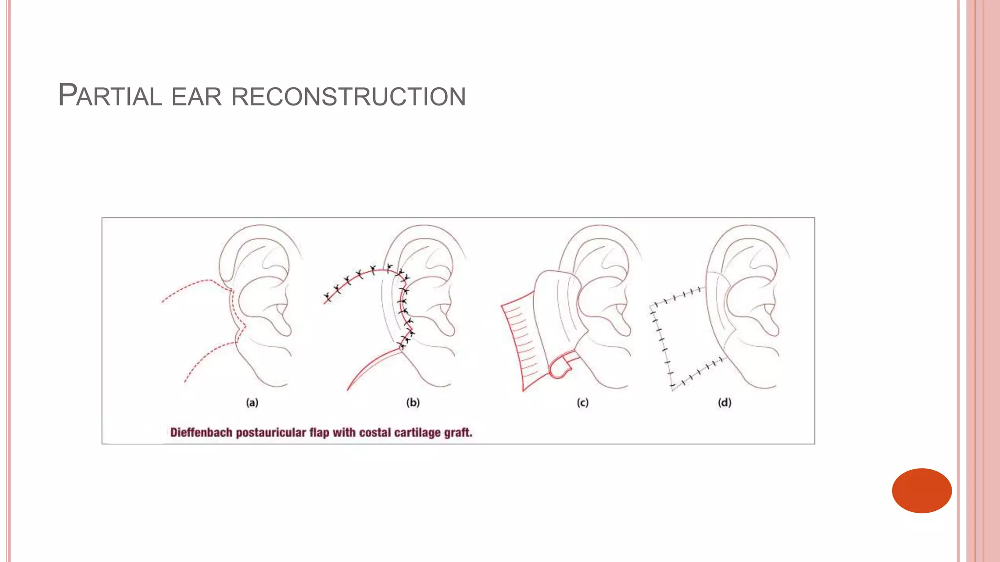 Reconstruction of ear | PPTX