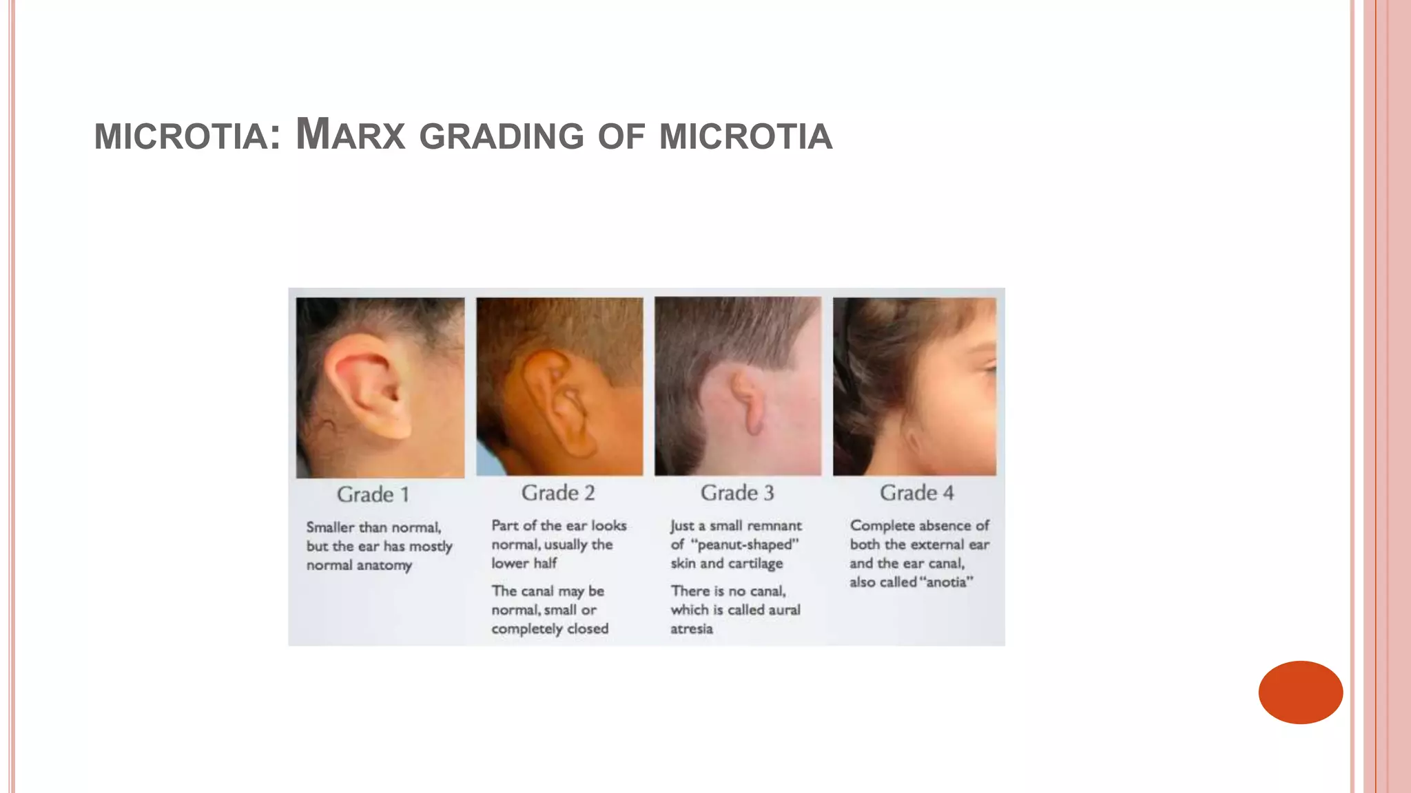 Reconstruction of ear | PPTX