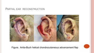 Reconstruction of ear | PPT