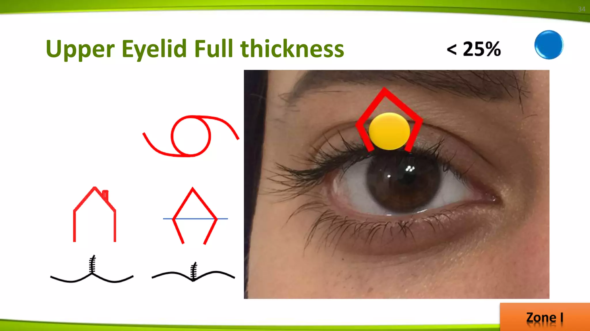 Reconstruction of eyelids defects | PPT