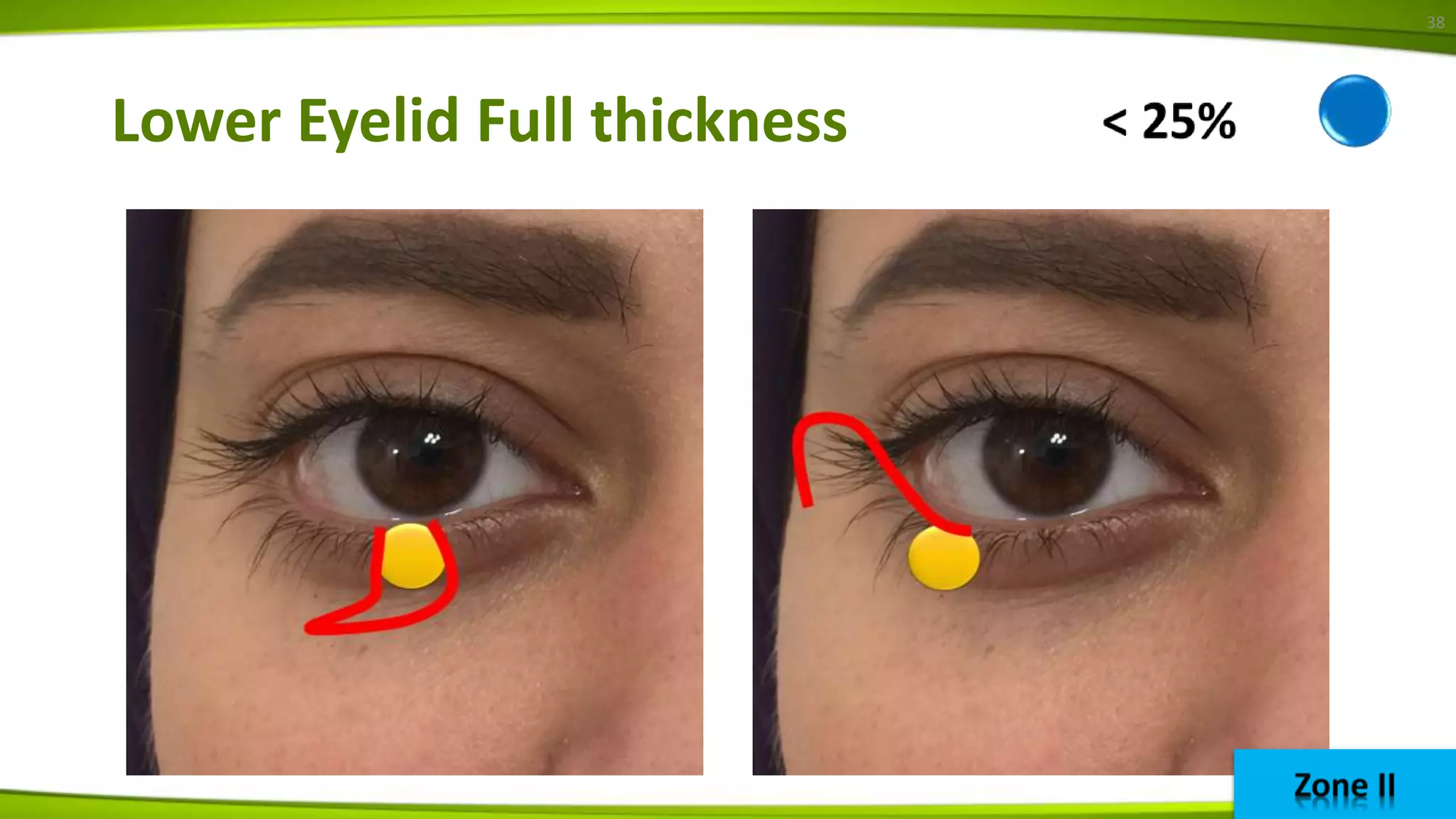 Reconstruction of eyelids defects | PPT