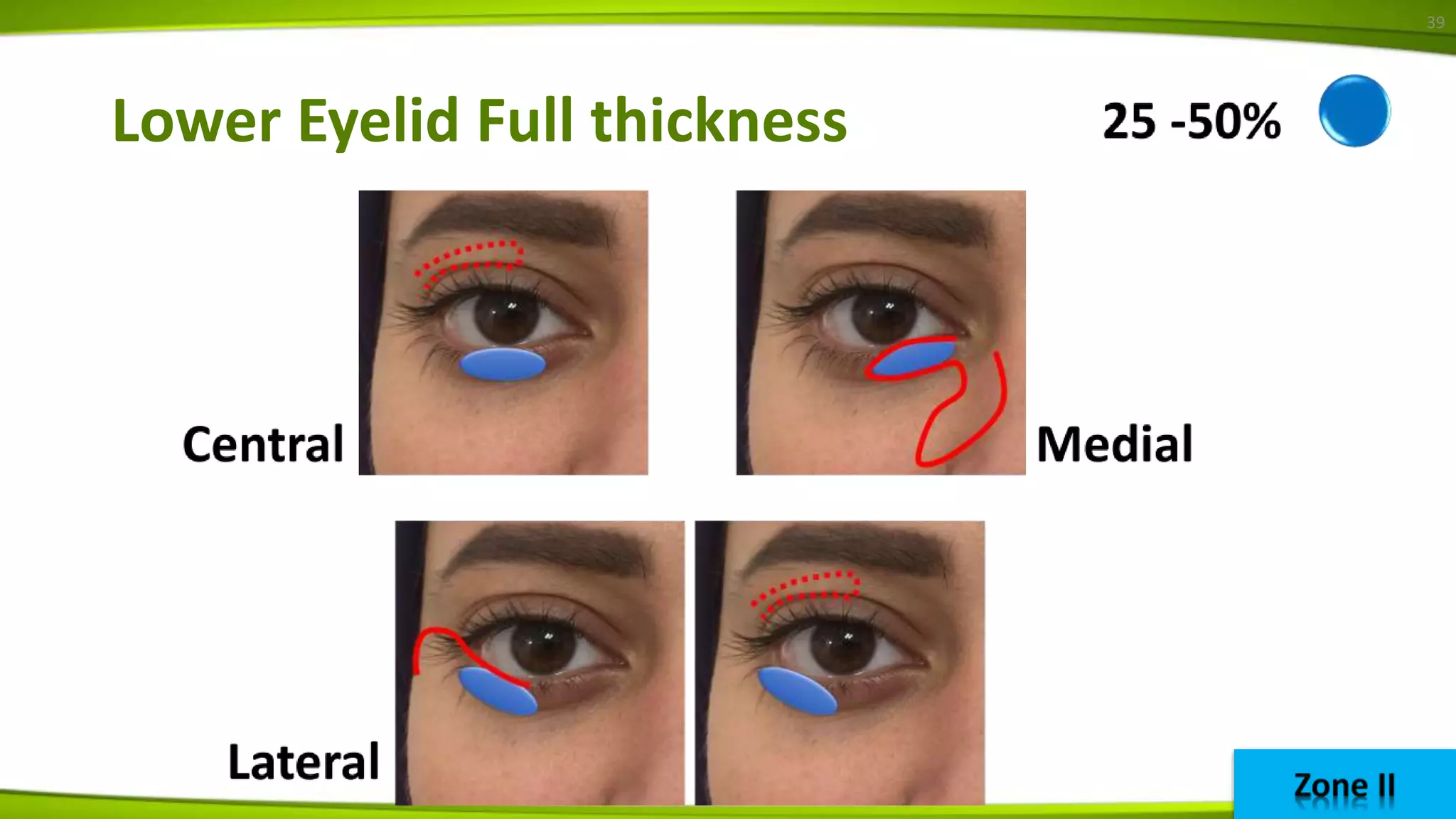 Reconstruction of eyelids defects | PPT