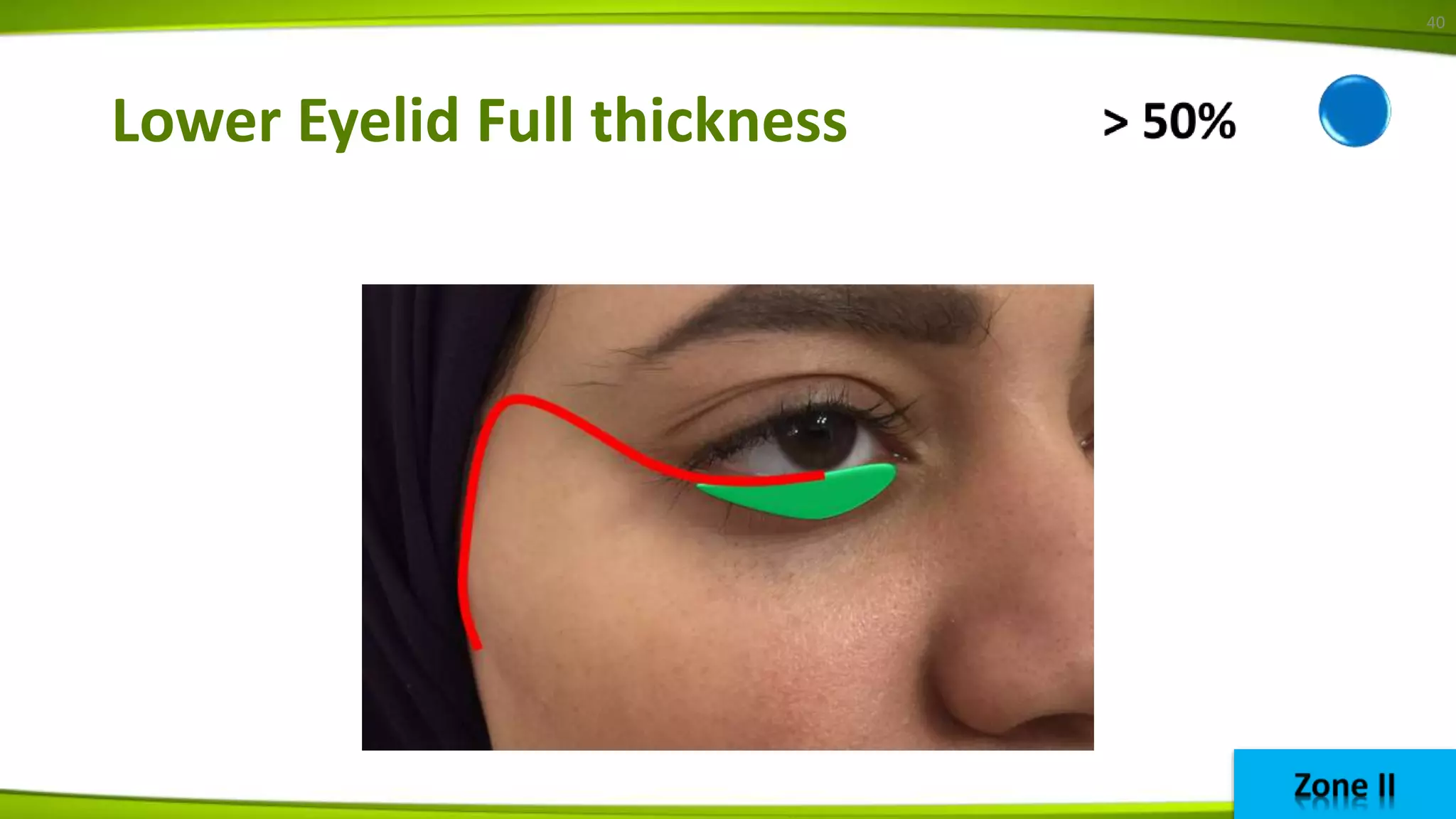 Reconstruction of eyelids defects | PPT