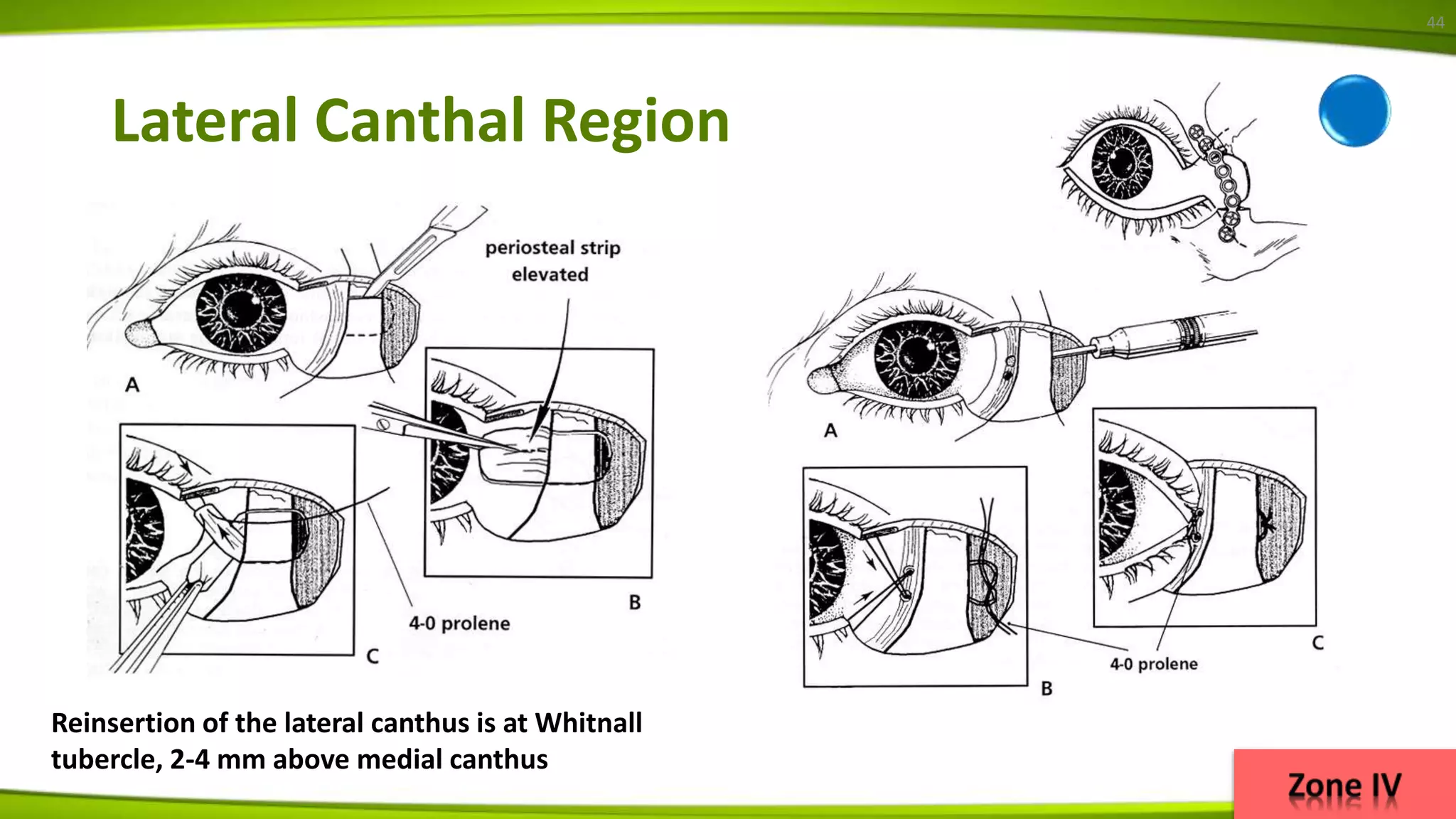 Reconstruction of eyelids defects | PPT