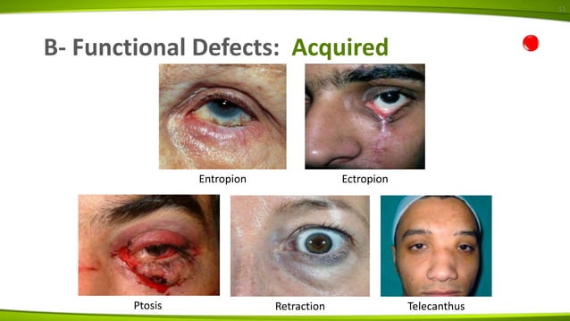 Reconstruction of eyelids defects | PPT