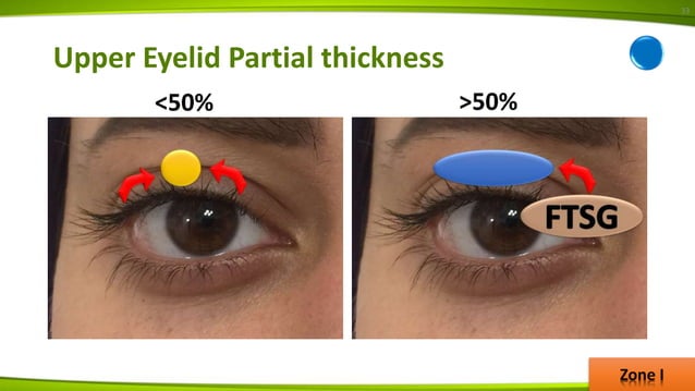 Reconstruction of eyelids defects | PPT
