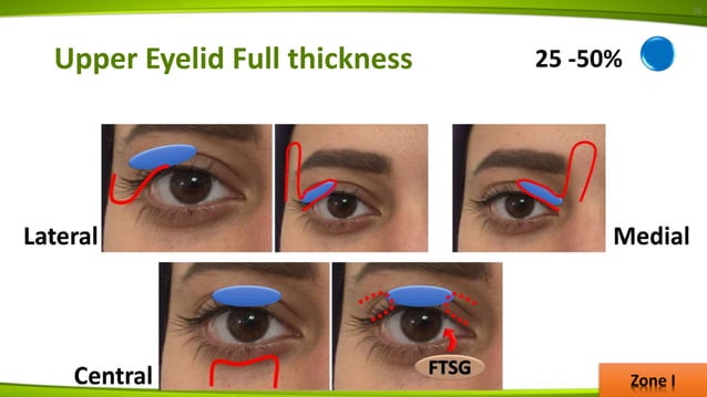 Reconstruction of eyelids defects | PPT