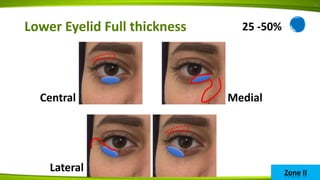 Reconstruction of eyelids defects | PPTX