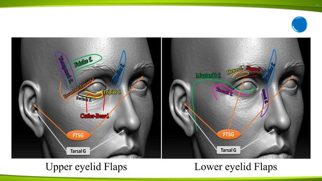 Reconstruction of eyelids defects | PPT