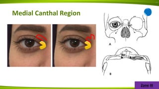 Reconstruction of eyelids defects | PPTX