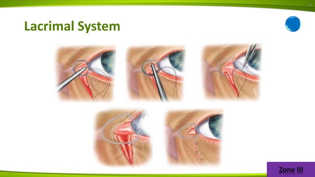 Reconstruction of eyelids defects | PPT