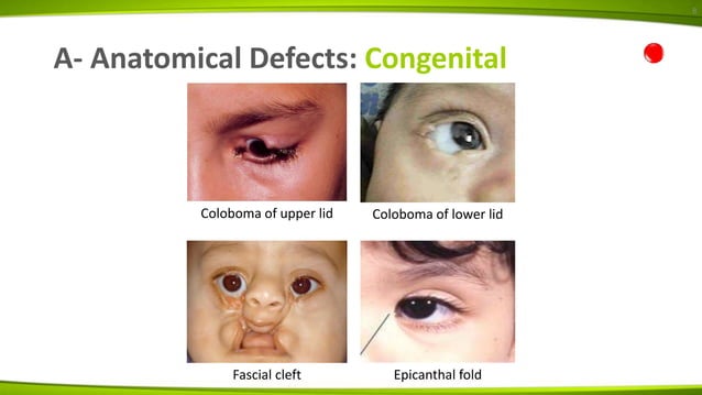 Reconstruction of eyelids defects | PPT