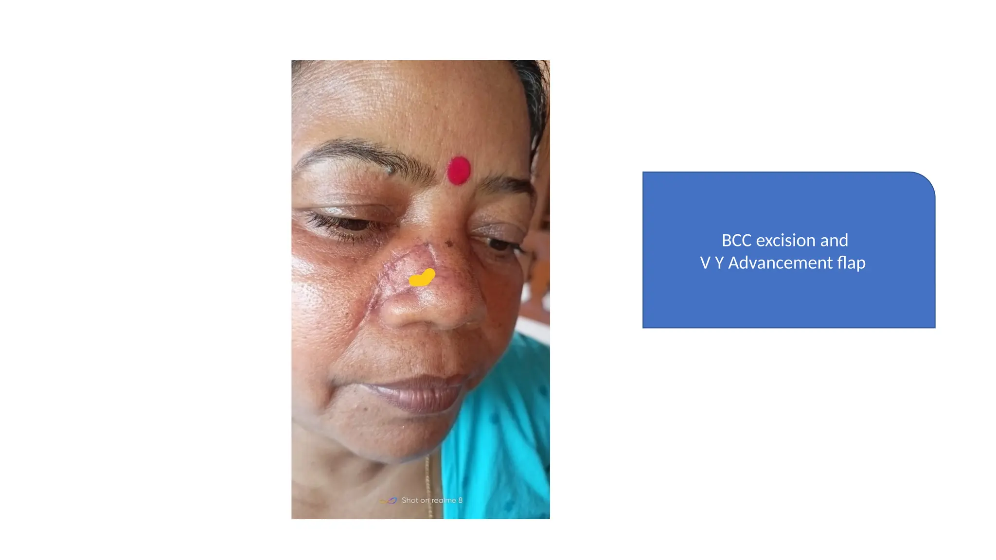 Reconstruction of head and neck defects –options portblair.pptx