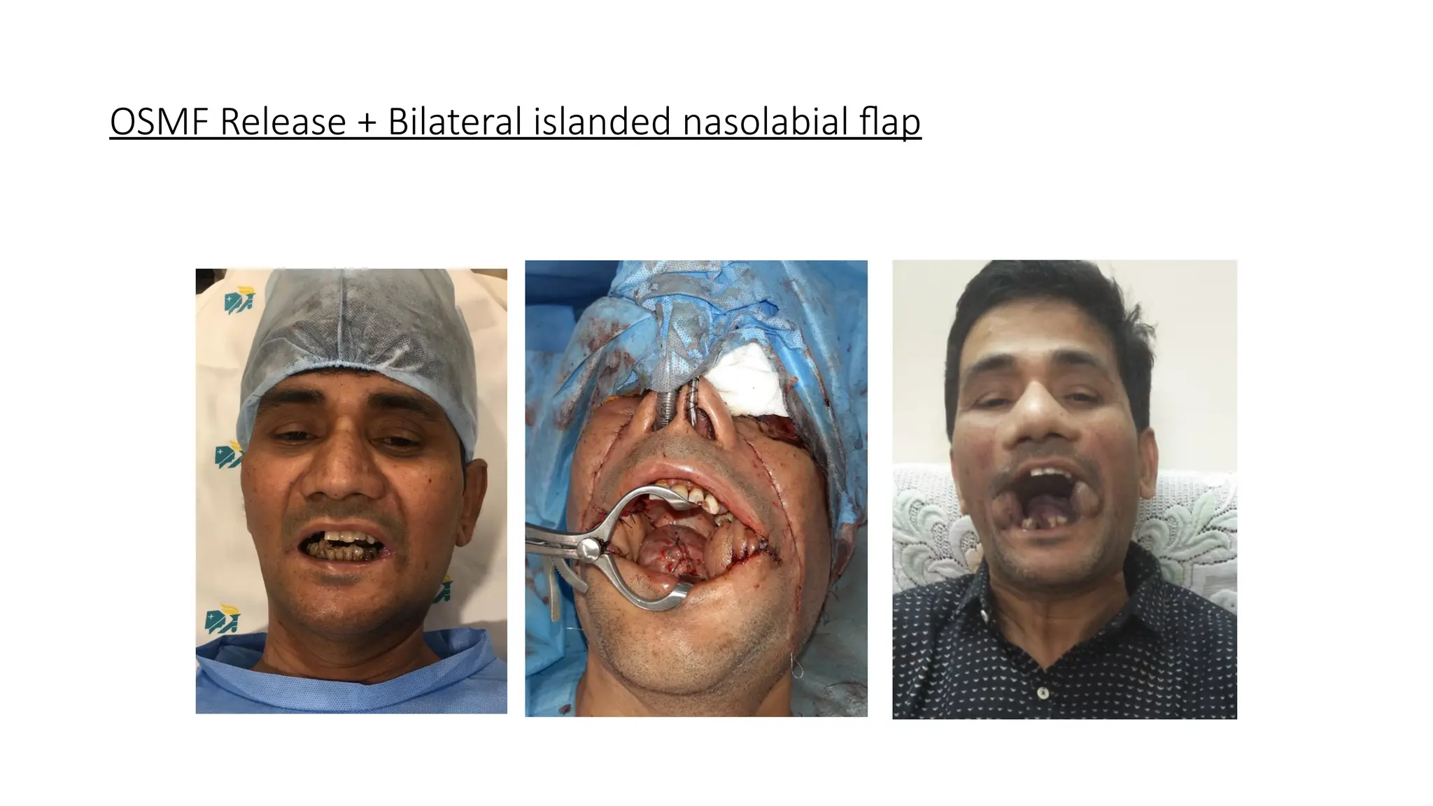 Reconstruction of head and neck defects –options portblair.pptx