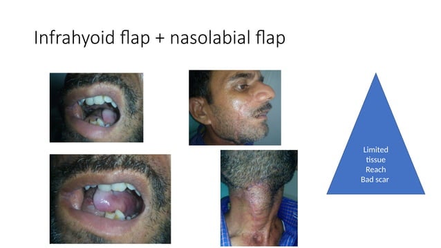 Reconstruction of head and neck defects –options portblair.pptx