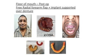 Reconstruction of head and neck defects –options portblair.pptx