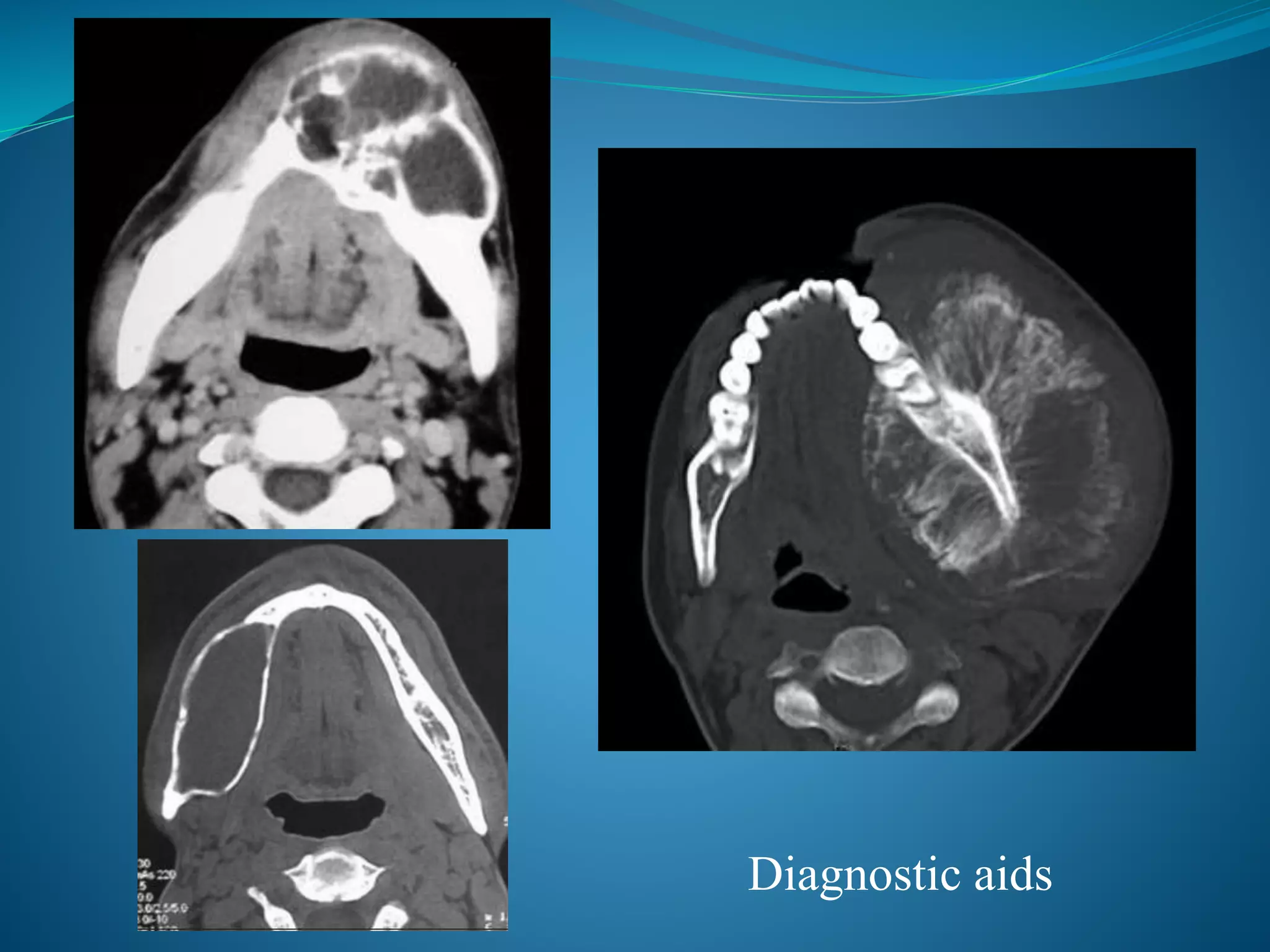 Reconstruction of mandibular defects | PPTX
