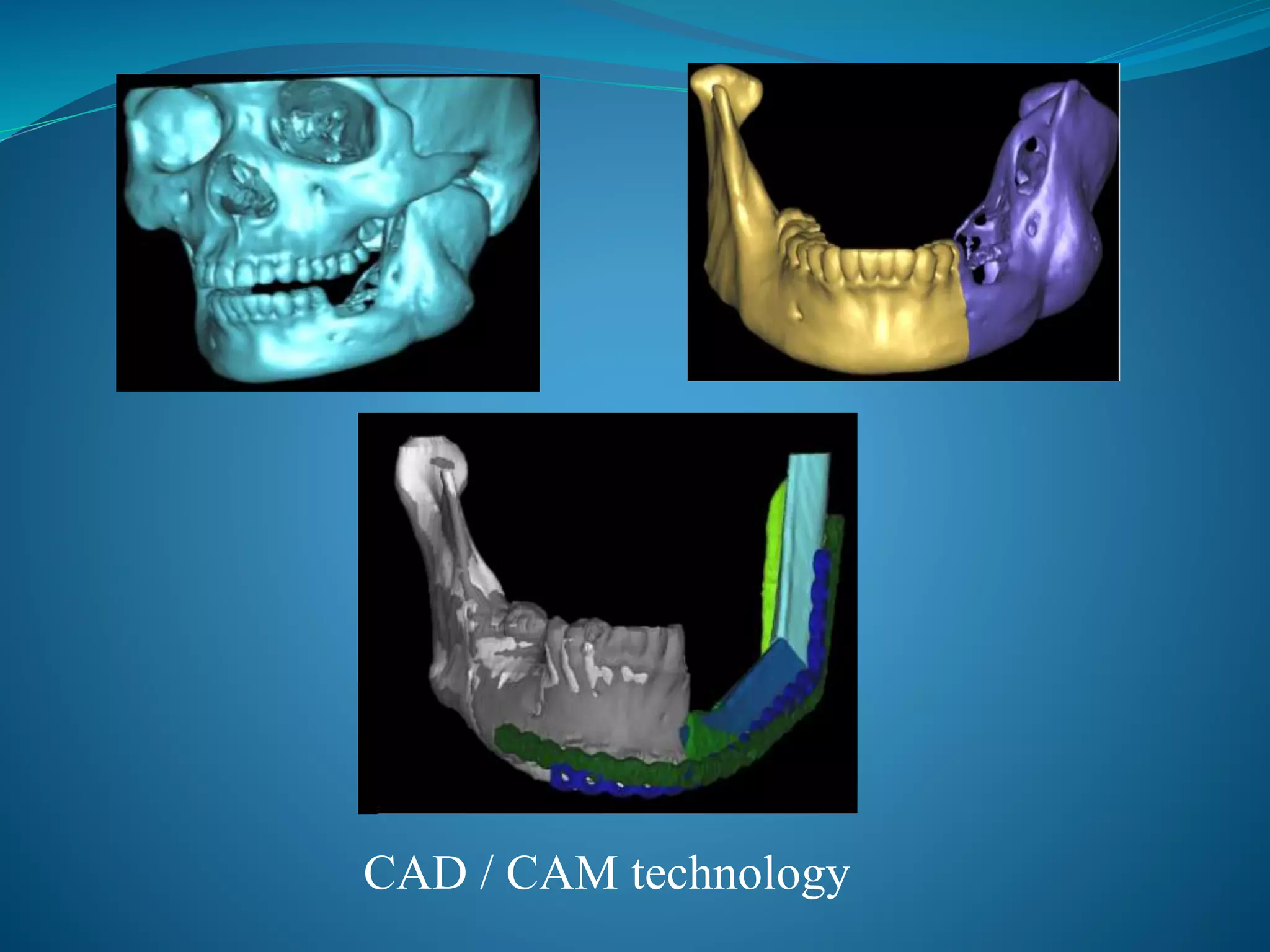 Reconstruction of mandibular defects | PPTX