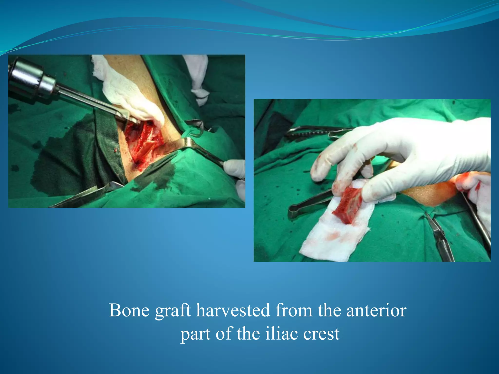 Reconstruction of mandibular defects | PPTX