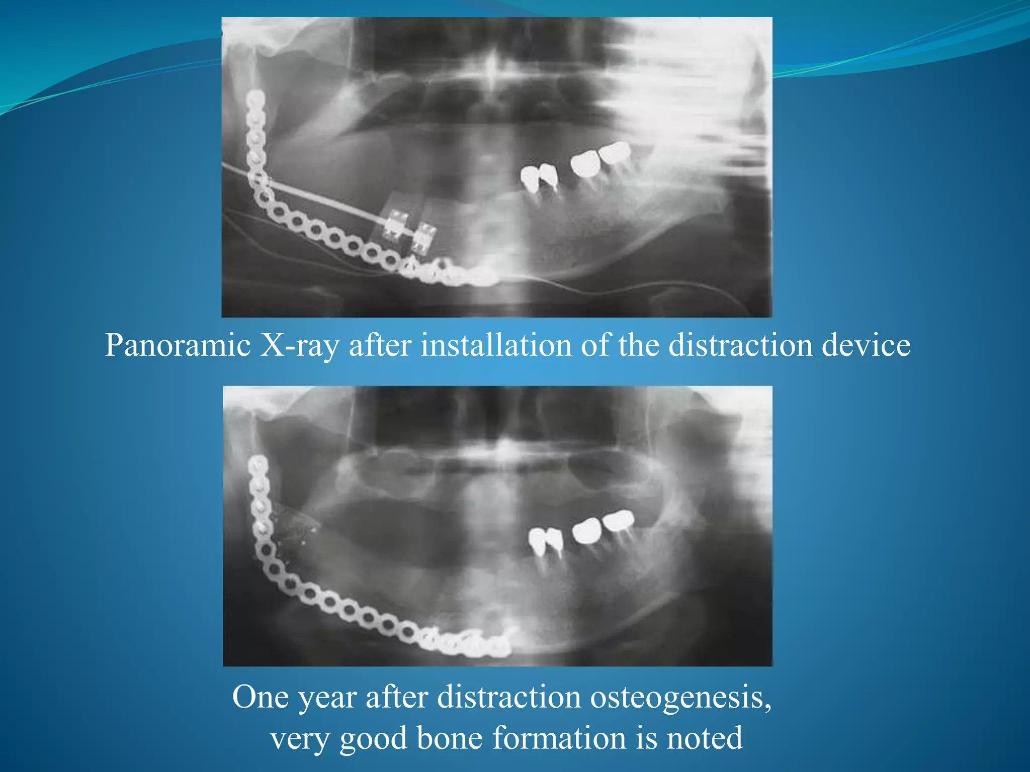 Reconstruction of mandibular defects | PPTX