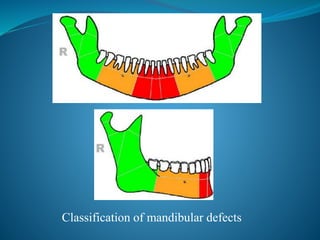 Reconstruction of mandibular defects | PPT