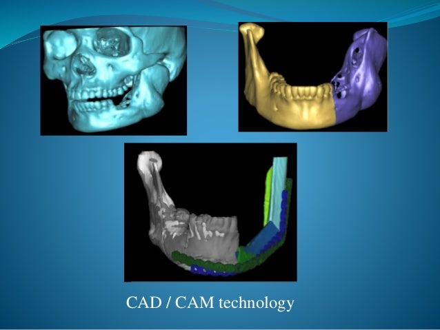 Reconstruction of mandibular defects