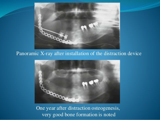 Reconstruction of mandibular defects
