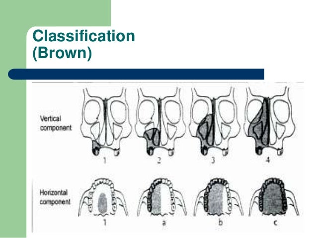 Reconstruction of maxilla
