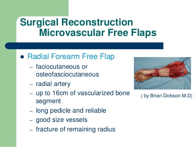 Reconstruction of maxilla