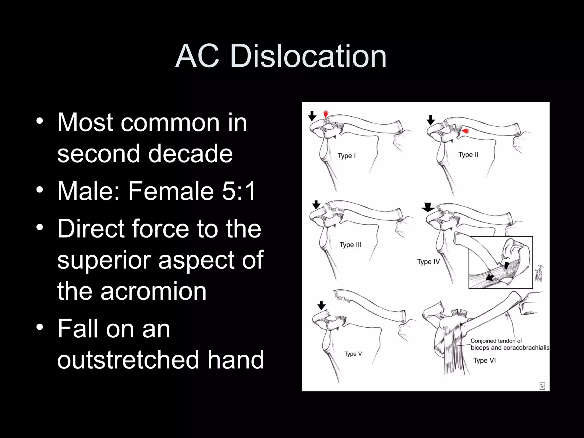 Reconstruction of Shoulder Separation and A.C. Dislocation | PPT