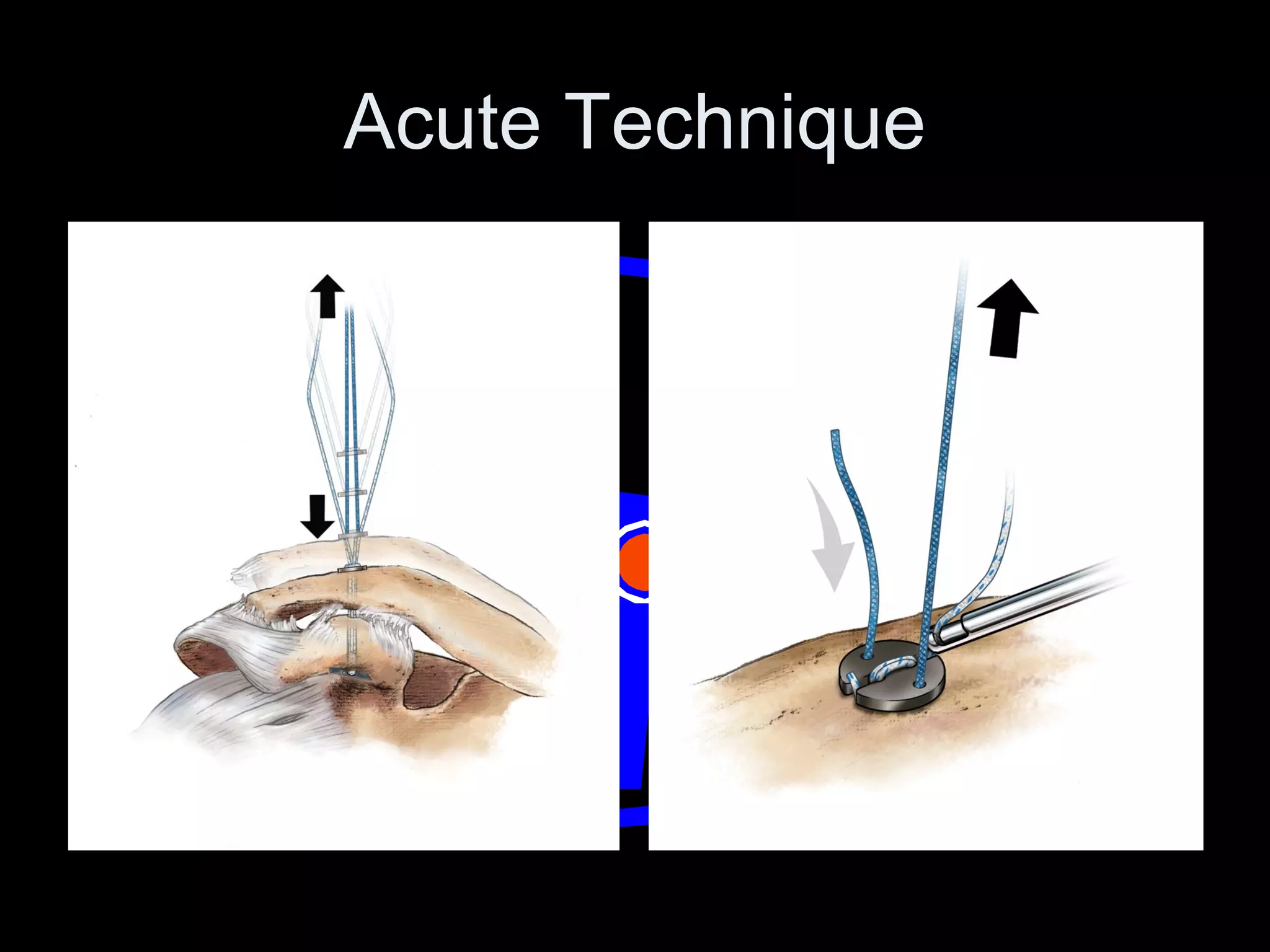 Reconstruction of Shoulder Separation and A.C. Dislocation | PPT
