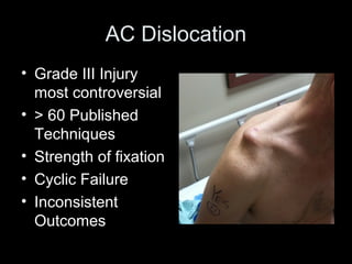 Reconstruction of Shoulder Separation and A.C. Dislocation | PPT