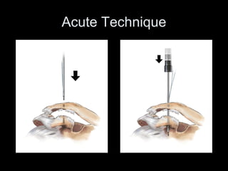 Reconstruction of Shoulder Separation and A.C. Dislocation | PPT