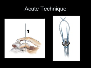 Reconstruction of Shoulder Separation and A.C. Dislocation | PPT