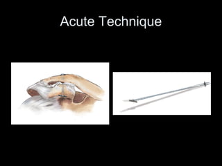 Reconstruction of Shoulder Separation and A.C. Dislocation | PPT