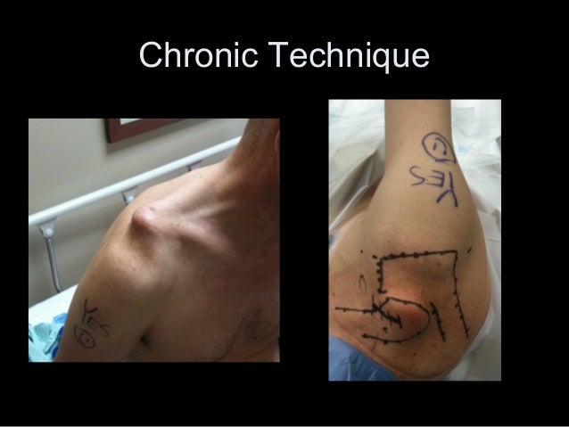 Reconstruction of Shoulder Separation and A.C. Dislocation