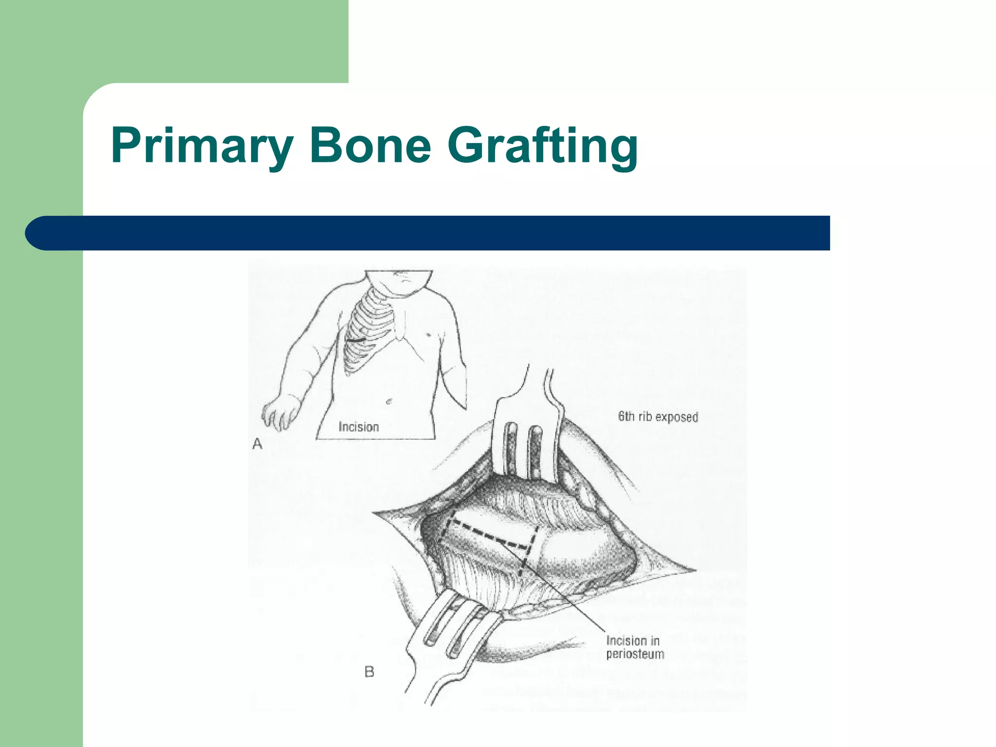 Reconstruction of the alveolar cleft | PPT