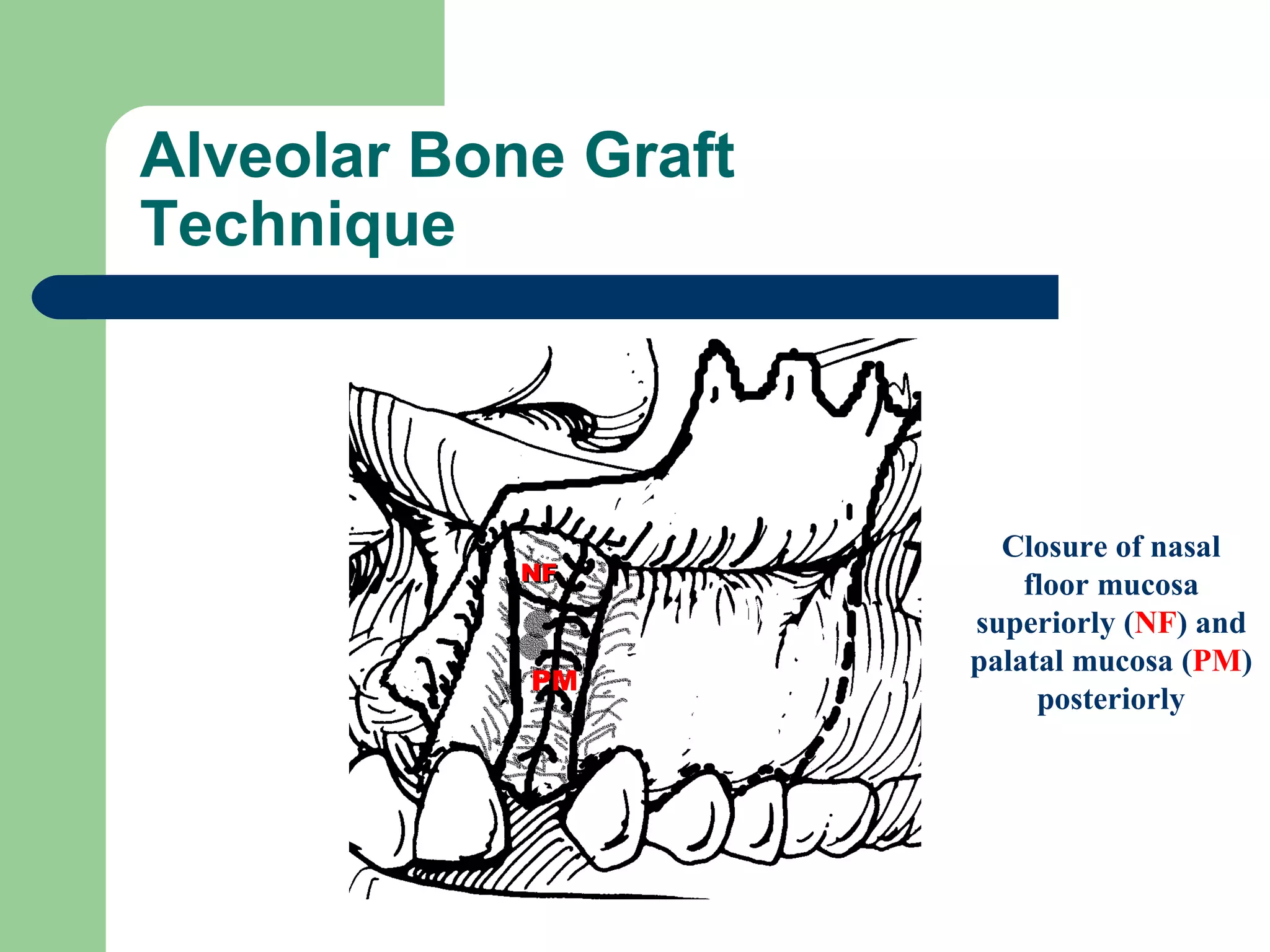 Reconstruction of the alveolar cleft | PPT