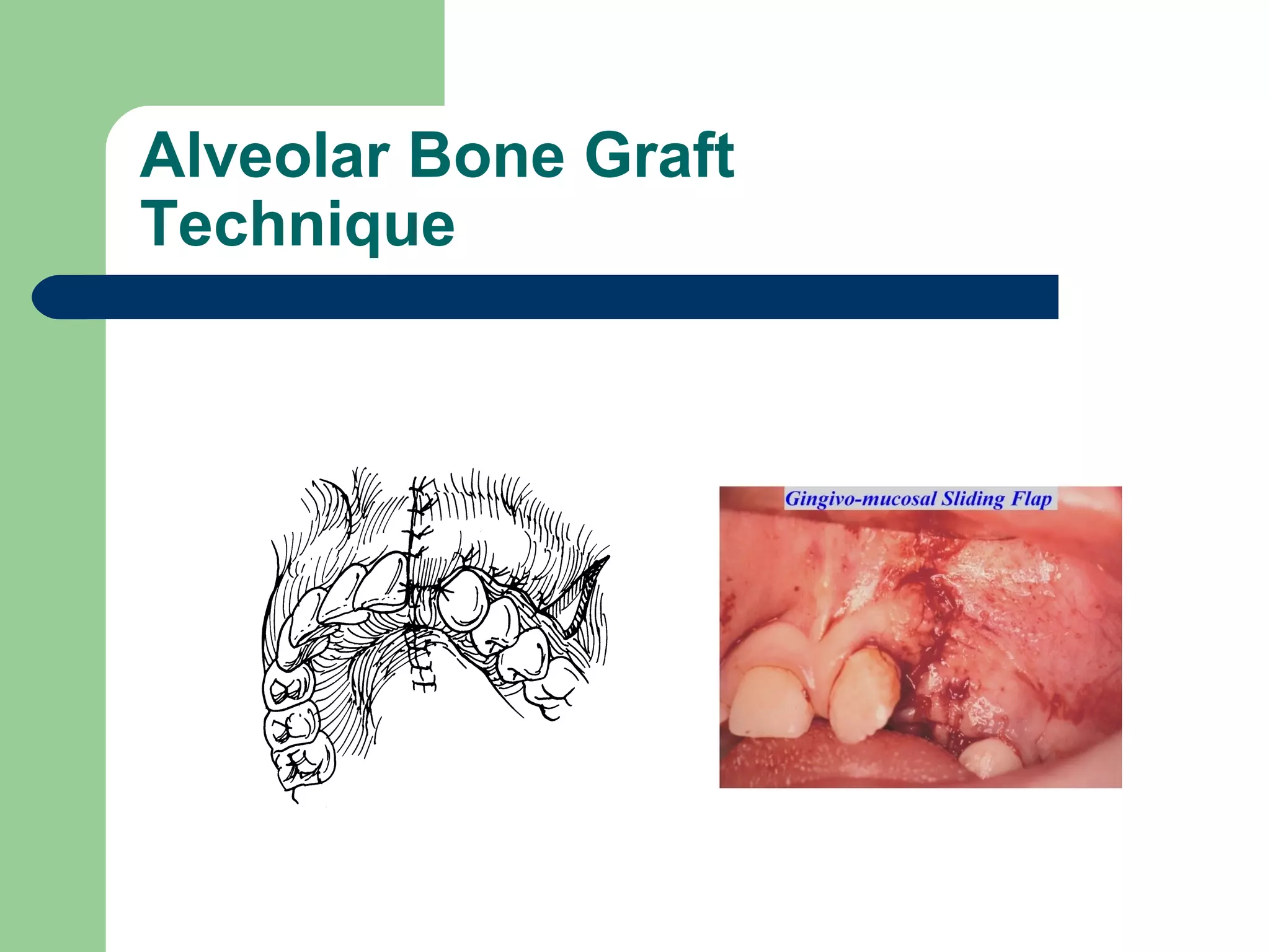 Reconstruction of the alveolar cleft | PPT