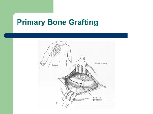 Reconstruction of the alveolar cleft | PPT