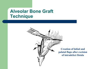 Reconstruction of the alveolar cleft | PPT