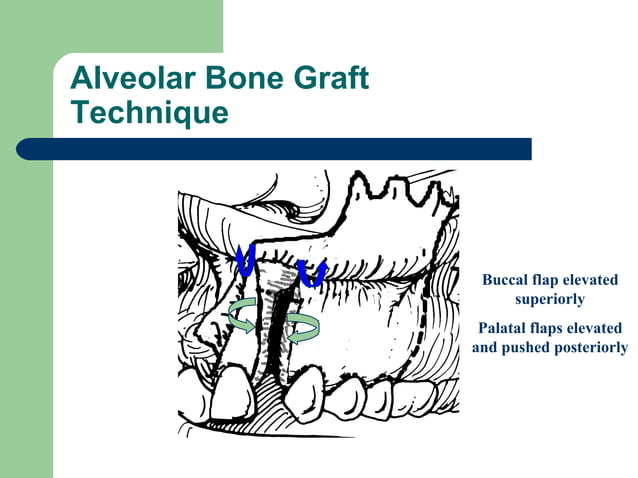 Reconstruction of the alveolar cleft