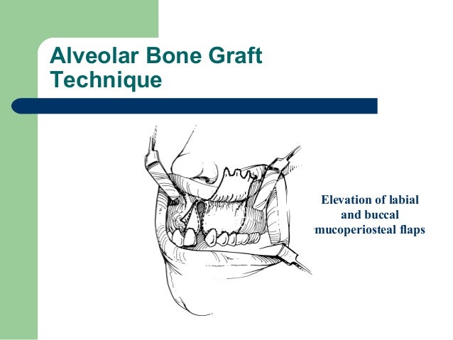 Reconstruction of the alveolar cleft