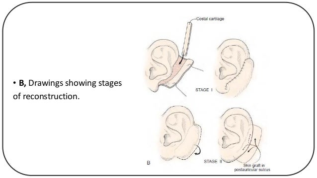Reconstruction of the auricle Dr. M. Erami