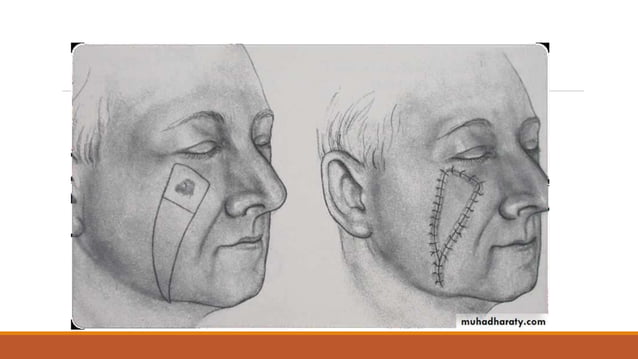 Reconstruction techniques in head and neck | PPTX | Death, Injury, or ...