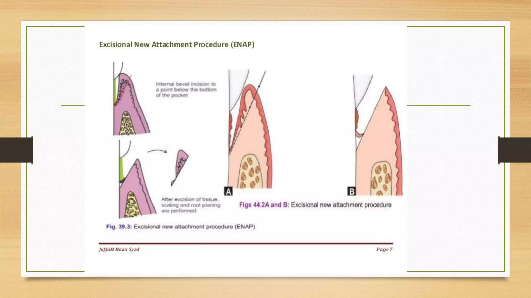 Reconstructive periodontal surgery | PPTX